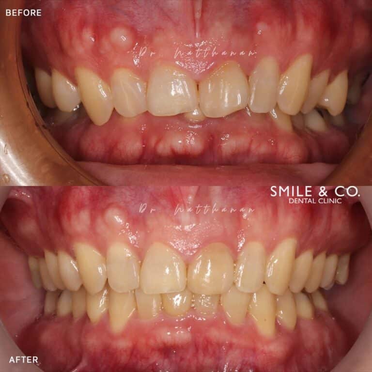 damon braces Before and After